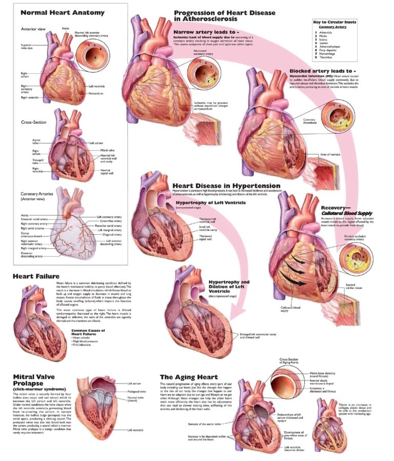 Heart Disease diagram | Anatomy System - Human Body Anatomy diagram and ...