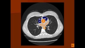 Normal Chest Ct With Labels | Anatomy System - Human Body Anatomy ...