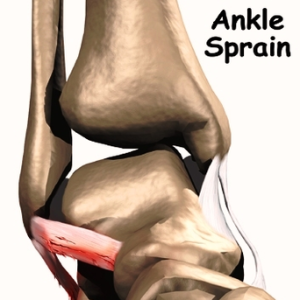 ankle sprain chart | Anatomy System - Human Body Anatomy diagram and ...