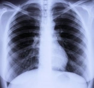 chest ray istock xsmall | Anatomy System - Human Body Anatomy diagram ...