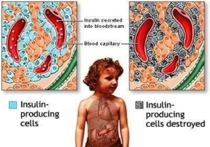 diabetes type | Anatomy System - Human Body Anatomy diagram and chart ...