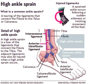 diagram of high ankle sprain | Anatomy System - Human Body Anatomy ...