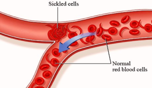 diagram sickle cell disease | Anatomy System - Human Body Anatomy ...
