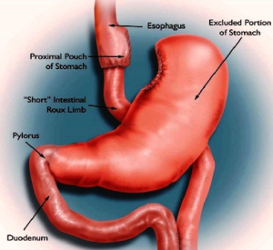 gastric bypass | Anatomy System - Human Body Anatomy diagram and chart ...