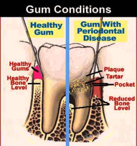 gum diagram | Anatomy System - Human Body Anatomy diagram and chart images