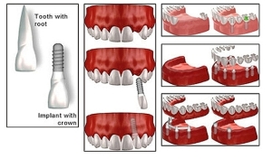 implants | Anatomy System - Human Body Anatomy diagram and chart images
