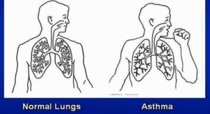 asthma inhaler | Anatomy System - Human Body Anatomy diagram and chart ...