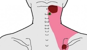 referral multifidi mid cervical | Anatomy System - Human Body Anatomy ...