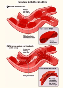 Sickle Cell | Anatomy System - Human Body Anatomy diagram and chart images