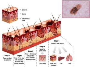 cancer types | Anatomy System - Human Body Anatomy diagram and chart images