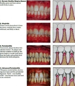stages of perio | Anatomy System - Human Body Anatomy diagram and chart ...