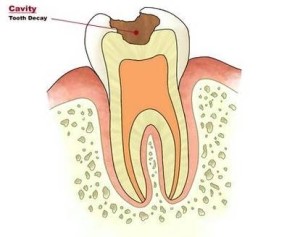 Tooth cavity | Anatomy System - Human Body Anatomy diagram and chart images