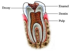 tooth decay photo | Anatomy System - Human Body Anatomy diagram and ...